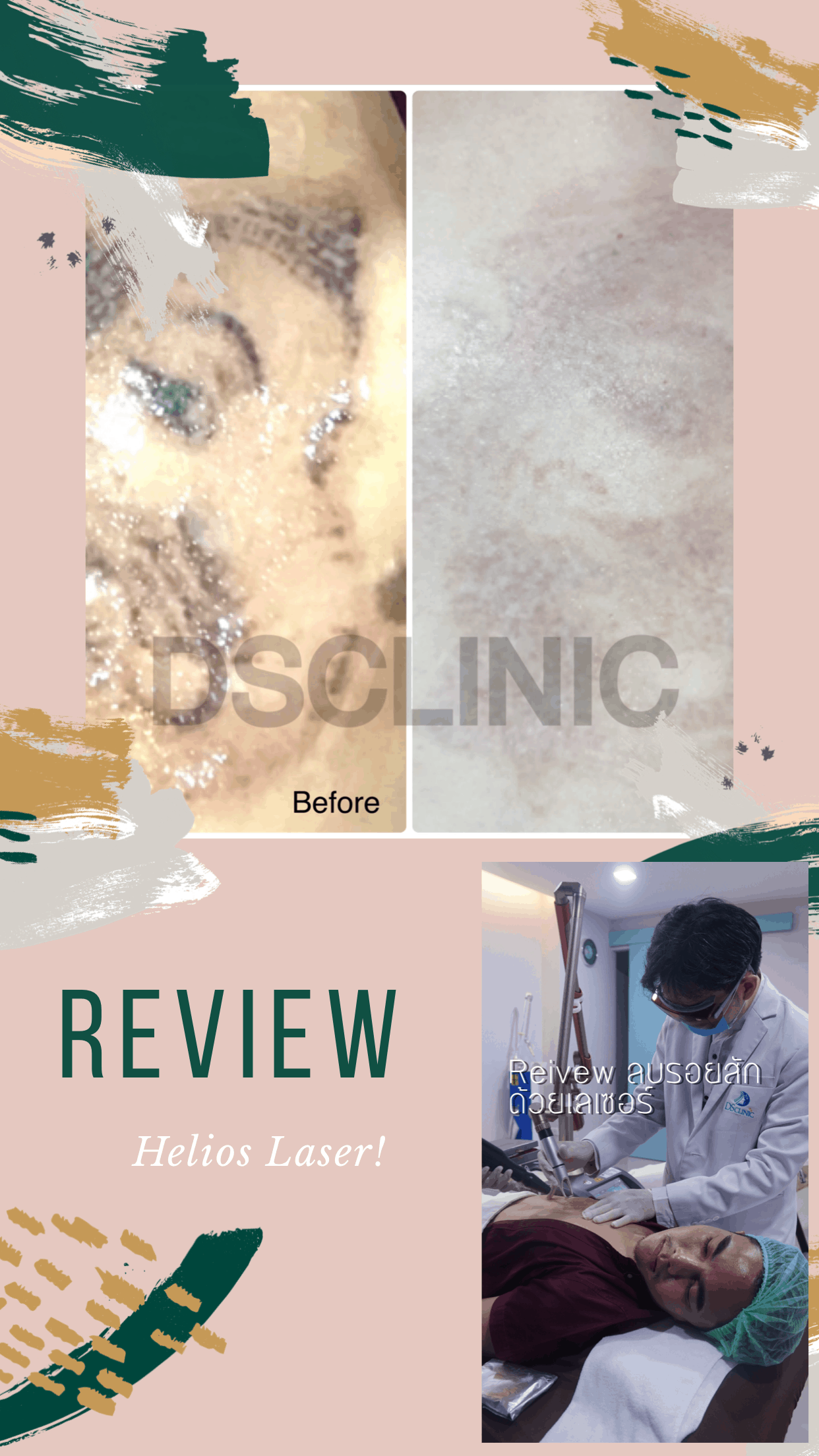 ลบรอยสัก Helios laser II เลเซอร์ลบรอยสัก กระ จุดด่างดำ Ds Cilnic